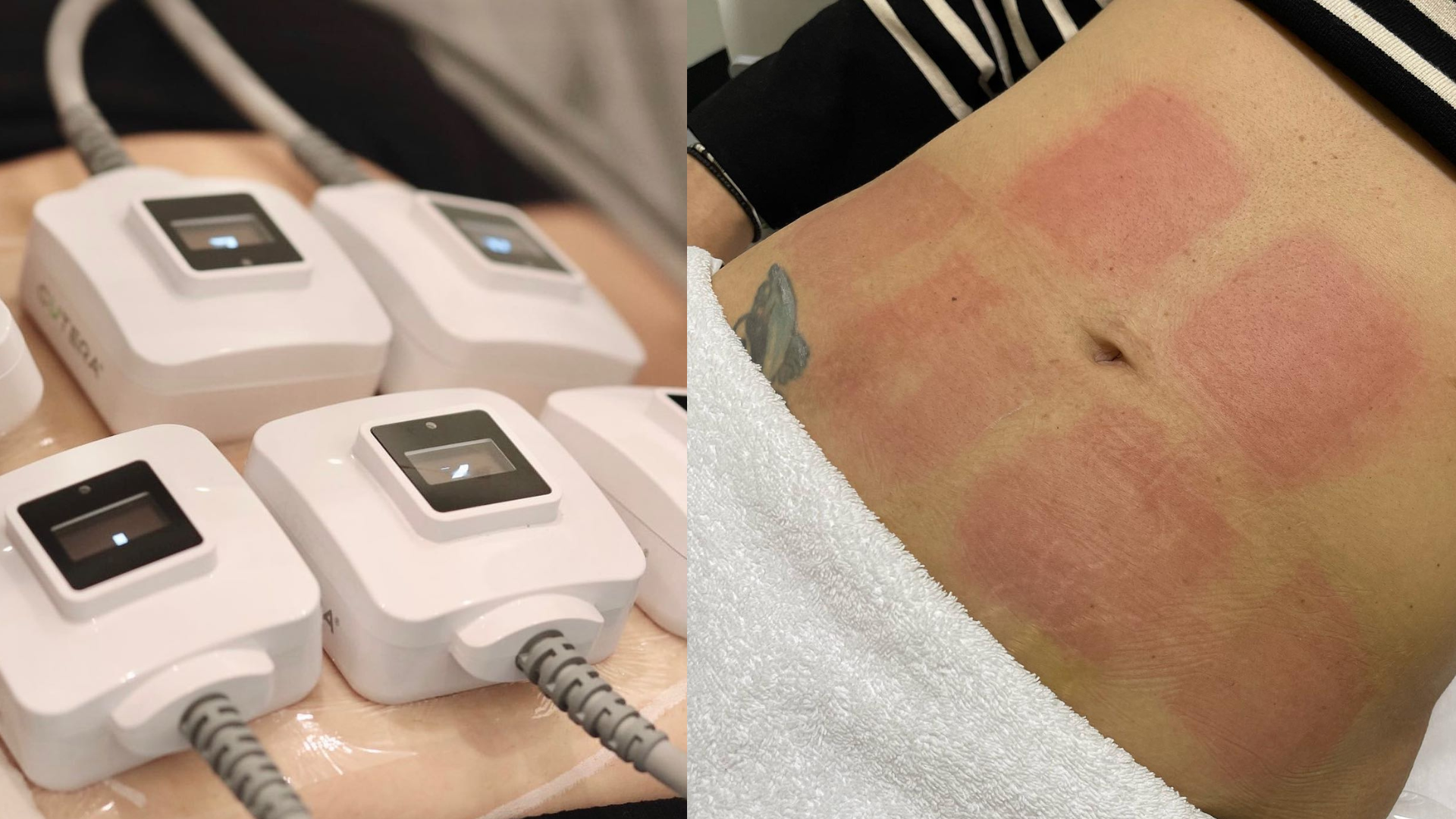 truSculpt Body Sculpting in Tasmania: Non-Invasive Treatment